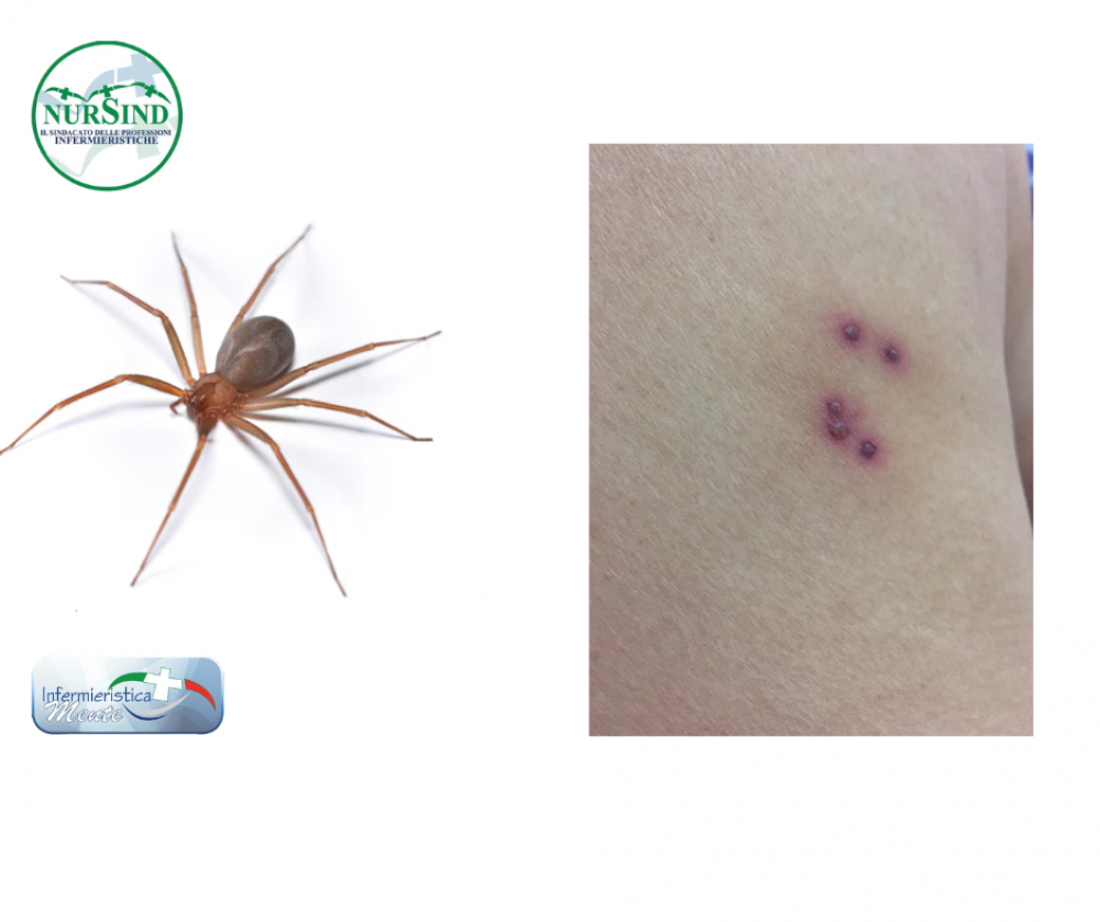 Morso ragno violino, i sintomi e come riconoscerlo ...