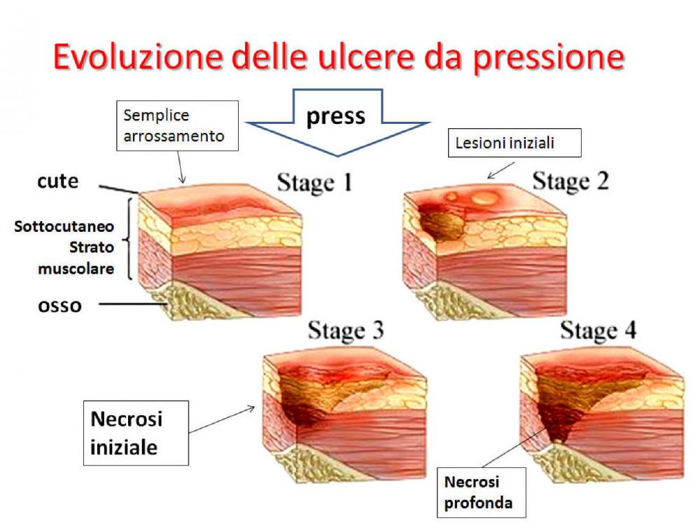 Infermieri. Classificazione delle ulcere: oggi di che colore sei ...